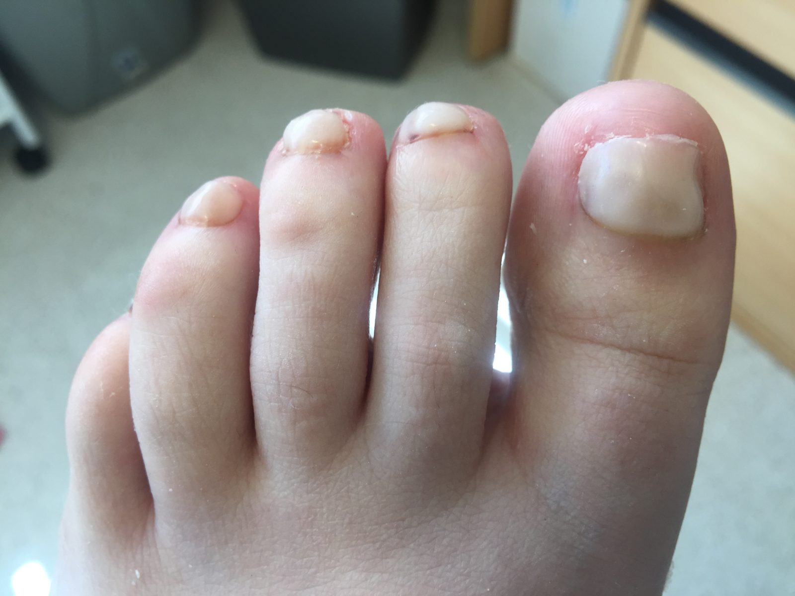 Effective Nail Reconstruction - Professional Podiatry / Chiropody 01455 ...