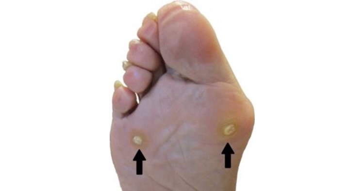 Causes of Corns and Calluses - Medipod Clinics - Hinckley 01455 246100
